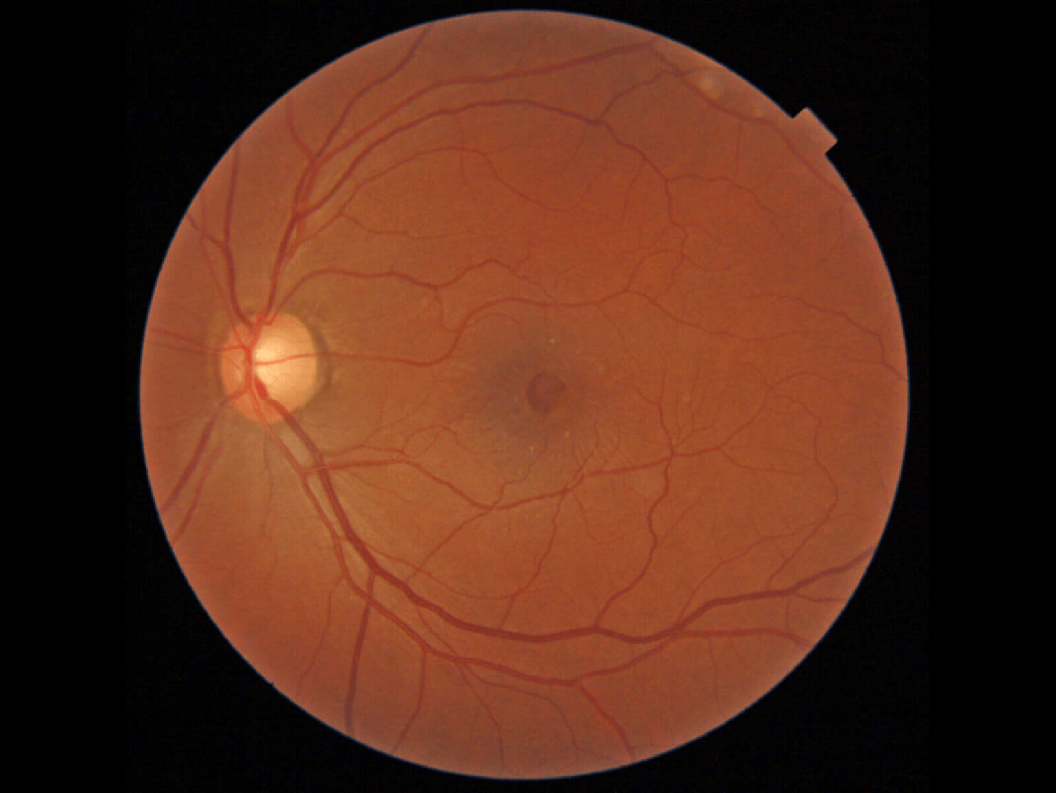 Epiretinal Membrane Treatment In Singapore - Eye Specialist Centre