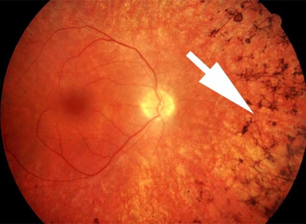 Hereditary Retina Conditions Treatment In SG - Eye Specialist Centre